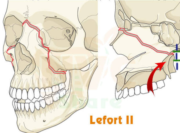 Gãy Lefort là gì? Chẩn đoán 3 phân loại, MINH HỌA rõ